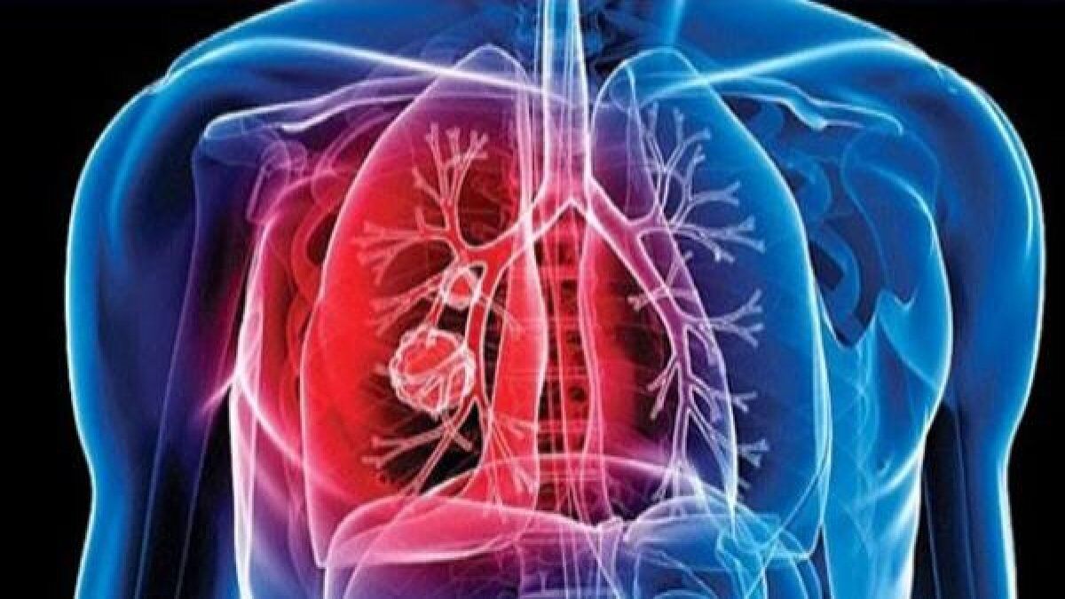 Covid-19 impact: 7% TB patients in India forced to discontinue ...