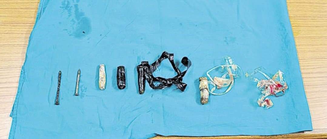 Blade, nails, tape: Doctors remove sharp objects from Chanchalguda ...