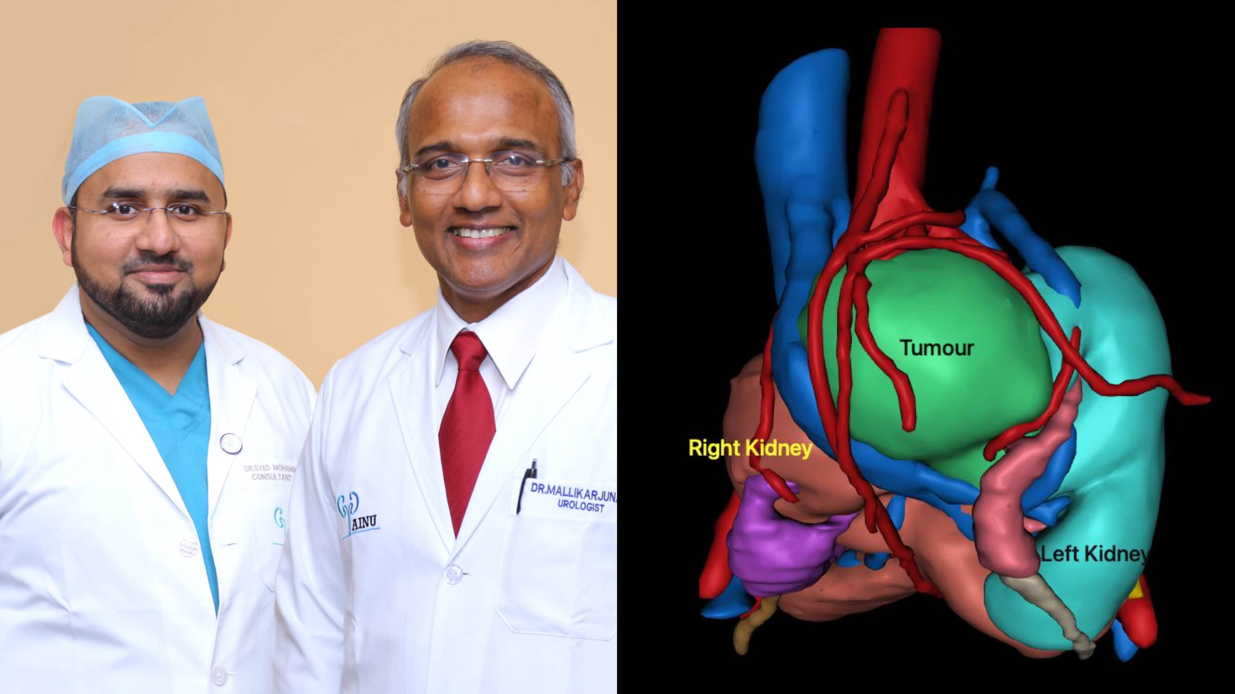 Rare pancake kidney tumour removed via keyhole surgery at Hyderabad AINU